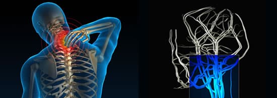 Myofascial Pain Rockville Centre, NY - Peripheral Neuralgia